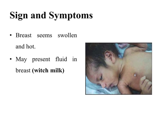 Engorged Breast.Samikshya.pptx | Pregnancy | Reproductive Health