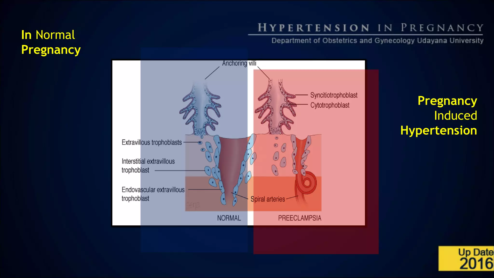 (Eng) pregnancy induced hypertension | PPT