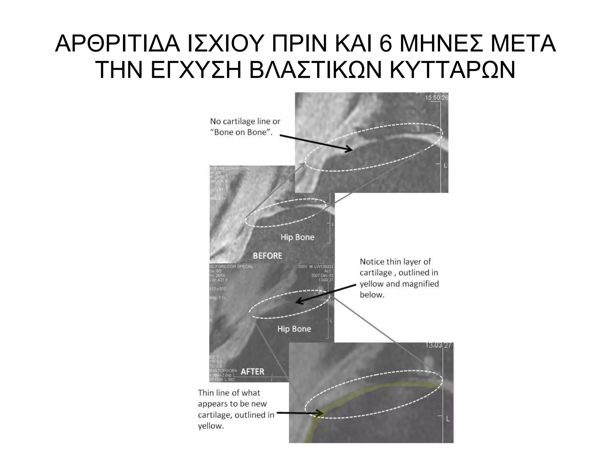 ΕΦΑΡΜΟΓΕΣ ΕΝΗΛΙΚΩΝ ΒΛΑΣΤΙΚΩΝ ΚΥΤΤΑΡΩΝ ΣΕ ΟΡΘΟΠΑΙΔΙΚΕΣ ΠΑΘΗΣΕΙΣ | PPT