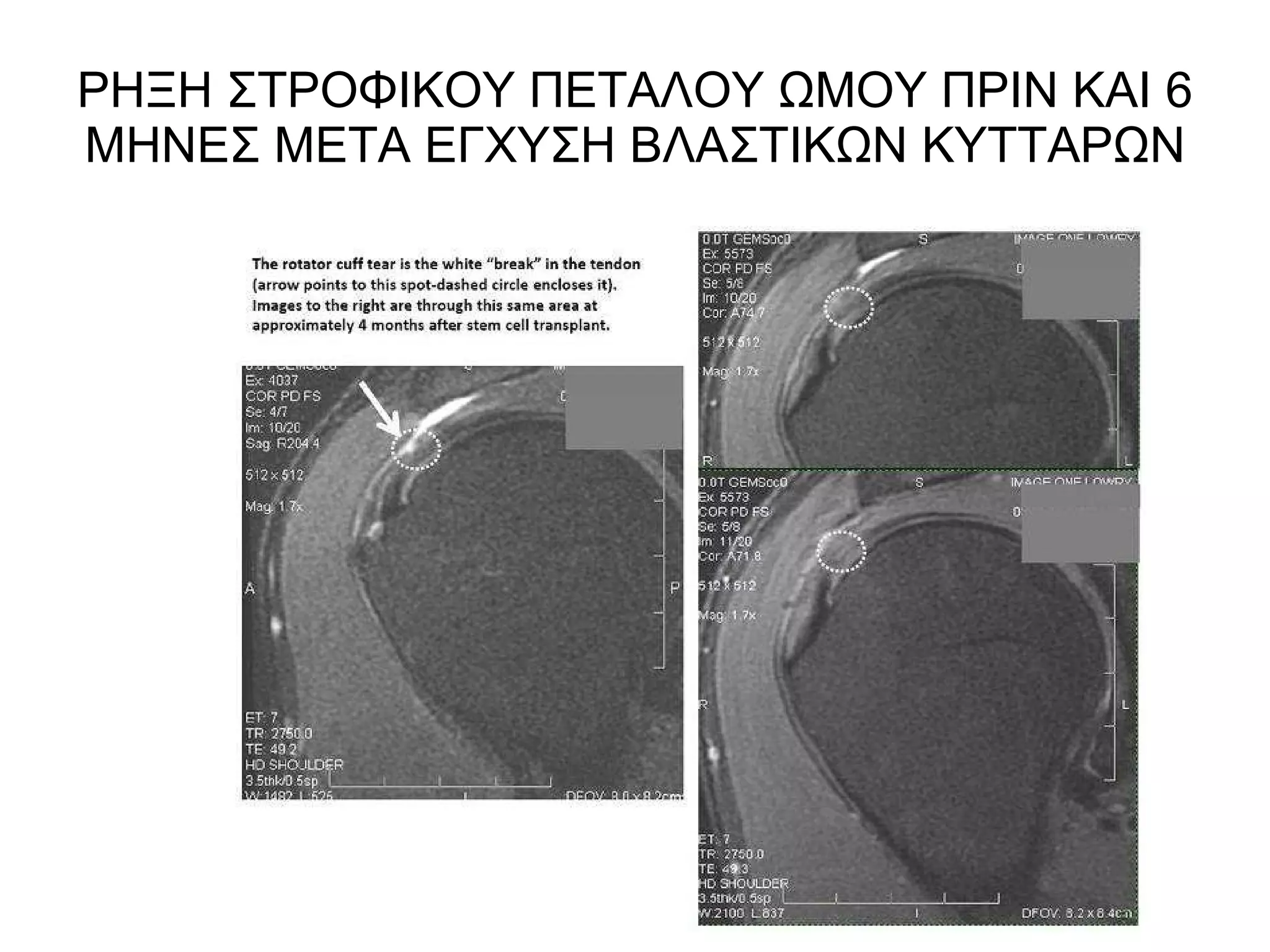 ΕΦΑΡΜΟΓΕΣ ΕΝΗΛΙΚΩΝ ΒΛΑΣΤΙΚΩΝ ΚΥΤΤΑΡΩΝ ΣΕ ΟΡΘΟΠΑΙΔΙΚΕΣ ΠΑΘΗΣΕΙΣ | PPT