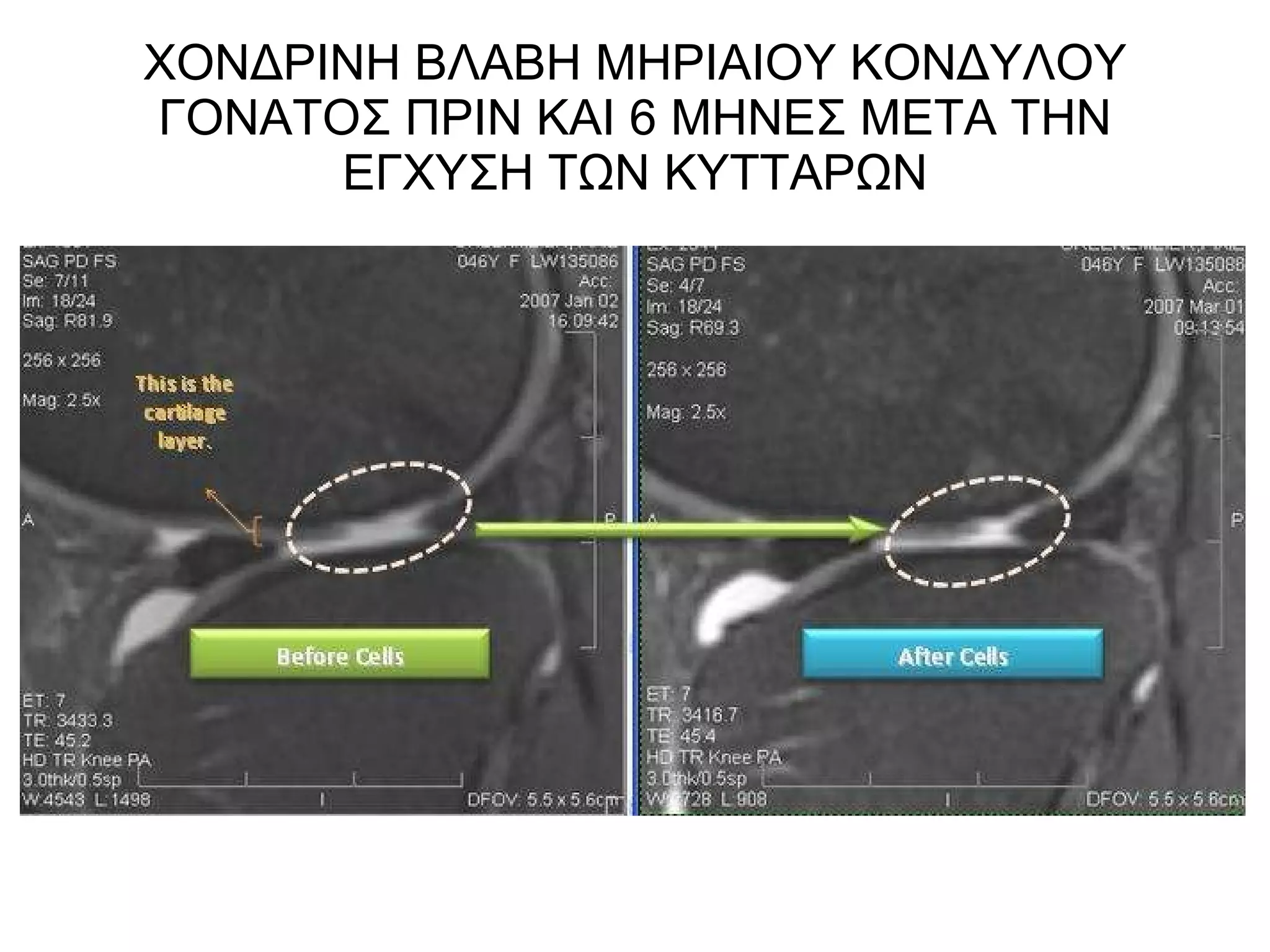ΕΦΑΡΜΟΓΕΣ ΕΝΗΛΙΚΩΝ ΒΛΑΣΤΙΚΩΝ ΚΥΤΤΑΡΩΝ ΣΕ ΟΡΘΟΠΑΙΔΙΚΕΣ ΠΑΘΗΣΕΙΣ | PPT