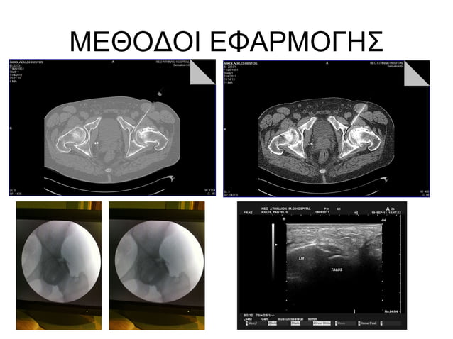 ΕΦΑΡΜΟΓΕΣ ΕΝΗΛΙΚΩΝ ΒΛΑΣΤΙΚΩΝ ΚΥΤΤΑΡΩΝ ΣΕ ΟΡΘΟΠΑΙΔΙΚΕΣ ΠΑΘΗΣΕΙΣ | PPT