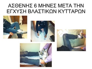 ΕΦΑΡΜΟΓΕΣ ΕΝΗΛΙΚΩΝ ΒΛΑΣΤΙΚΩΝ ΚΥΤΤΑΡΩΝ ΣΕ ΟΡΘΟΠΑΙΔΙΚΕΣ ΠΑΘΗΣΕΙΣ | PPT