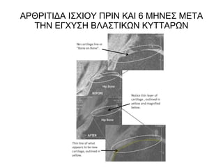 ΕΦΑΡΜΟΓΕΣ ΕΝΗΛΙΚΩΝ ΒΛΑΣΤΙΚΩΝ ΚΥΤΤΑΡΩΝ ΣΕ ΟΡΘΟΠΑΙΔΙΚΕΣ ΠΑΘΗΣΕΙΣ | PPT