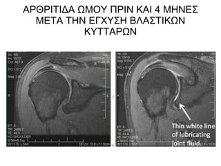 ΕΦΑΡΜΟΓΕΣ ΕΝΗΛΙΚΩΝ ΒΛΑΣΤΙΚΩΝ ΚΥΤΤΑΡΩΝ ΣΕ ΟΡΘΟΠΑΙΔΙΚΕΣ ΠΑΘΗΣΕΙΣ | PPT