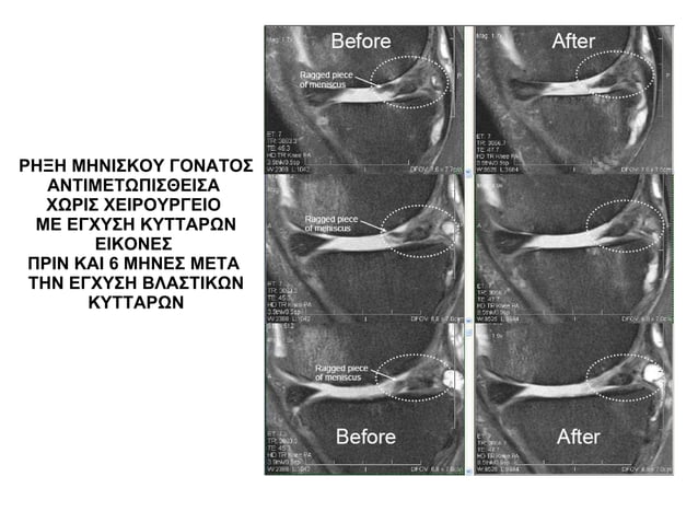 ΕΦΑΡΜΟΓΕΣ ΕΝΗΛΙΚΩΝ ΒΛΑΣΤΙΚΩΝ ΚΥΤΤΑΡΩΝ ΣΕ ΟΡΘΟΠΑΙΔΙΚΕΣ ΠΑΘΗΣΕΙΣ | PPT