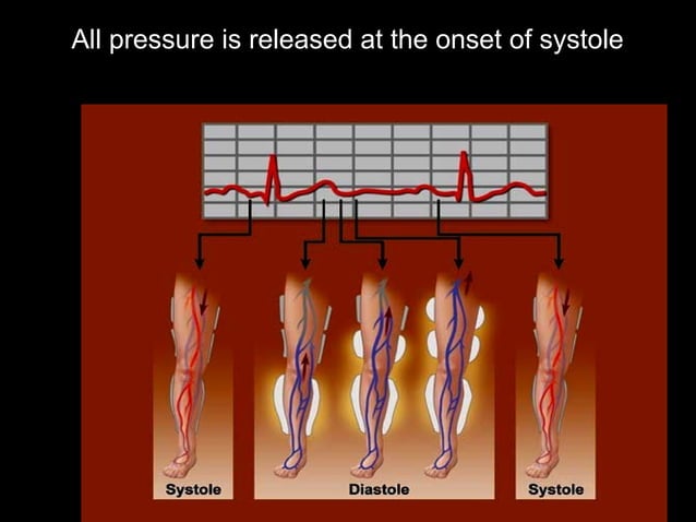 Enhanced external counterpulsation (eecp) role in | PPT | Heart and ...