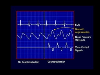 Enhanced external counterpulsation (eecp) role in | PPT