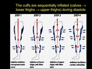 Enhanced external counterpulsation (eecp) role in | PPT