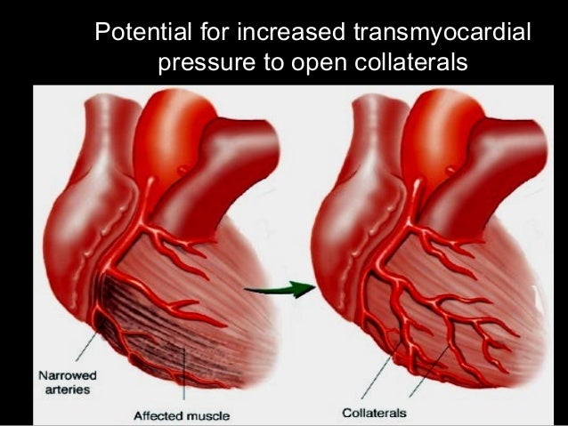 Enhanced external counterpulsation (eecp) role in