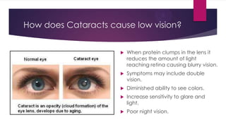 Enhancing Daily Living for Patients with Low Vision | PPT