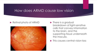 Enhancing Daily Living for Patients with Low Vision | PPTX