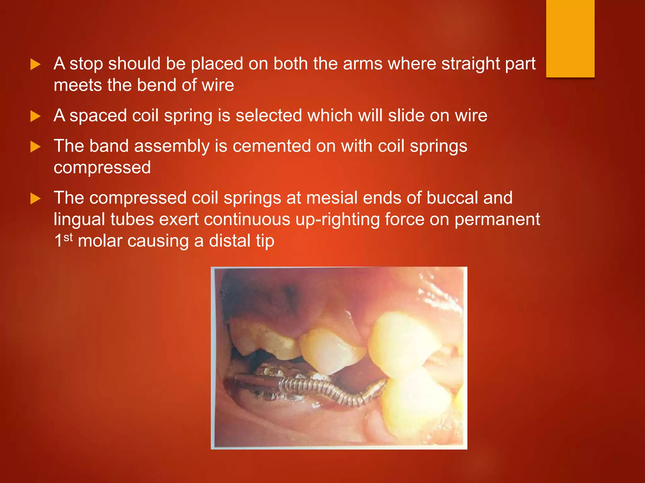 Space regaining procedure in pediatric dentistry | PPTX