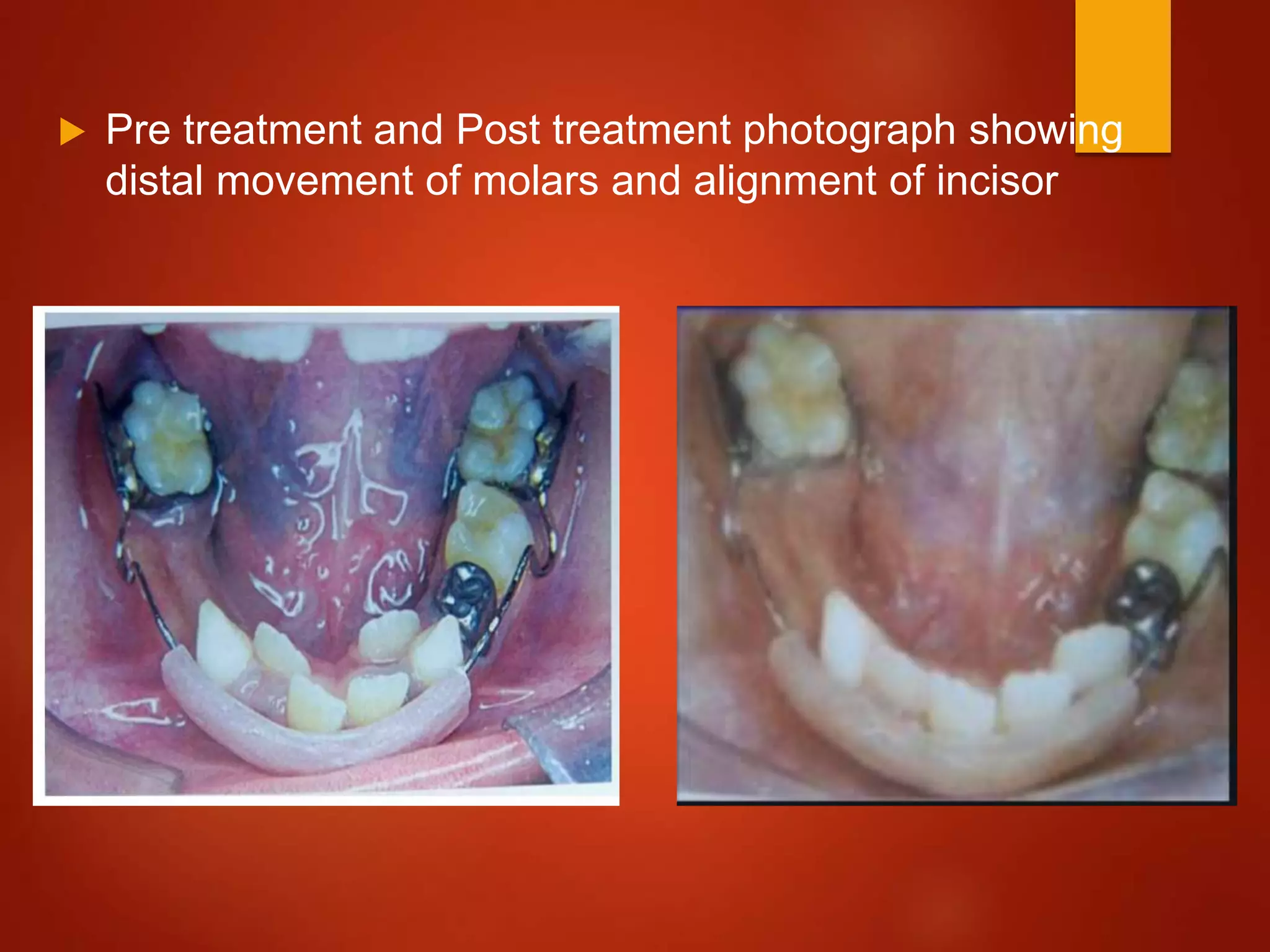 Space regaining procedure in pediatric dentistry | PPTX