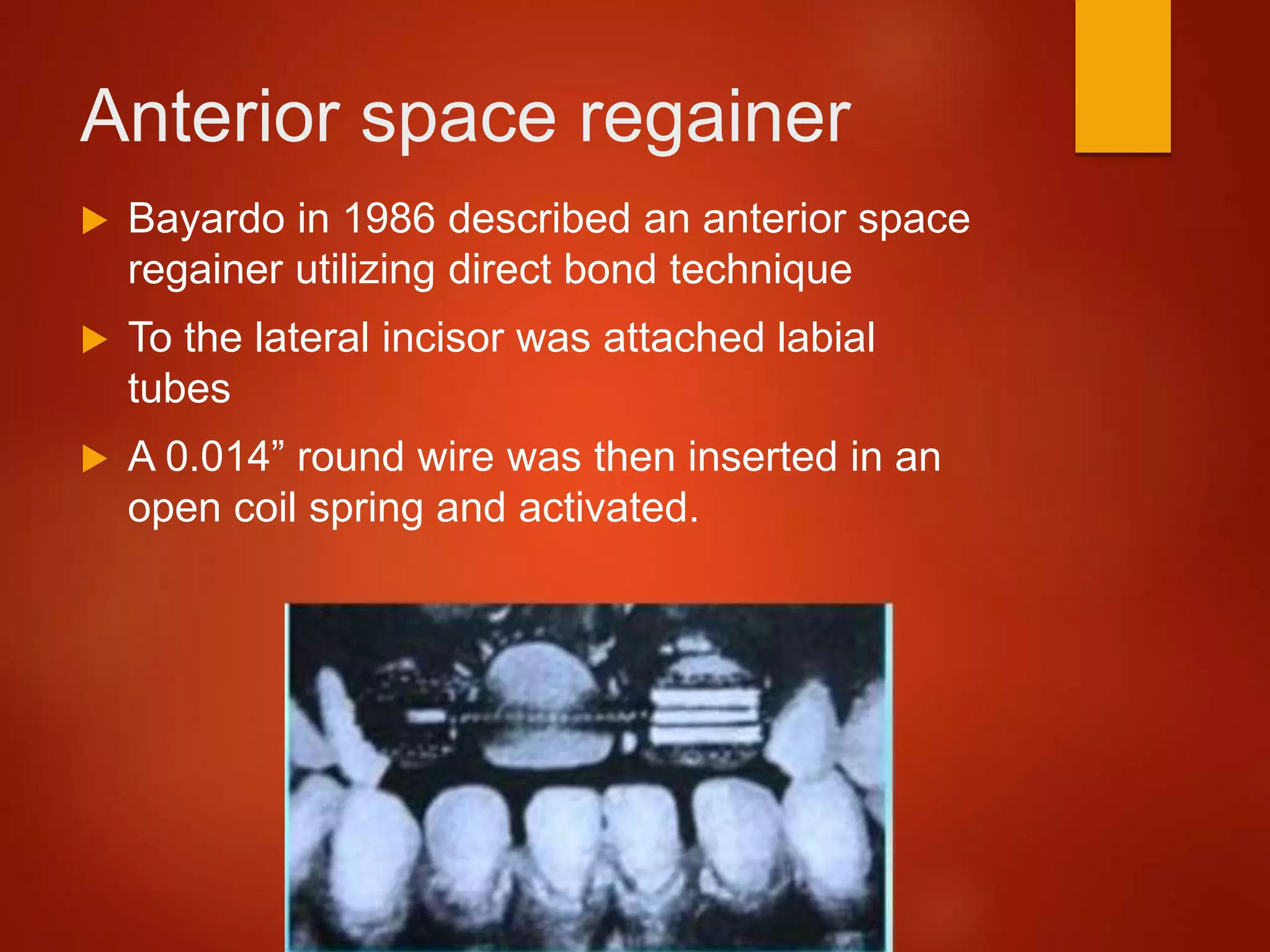 Space regaining procedure in pediatric dentistry | PPTX