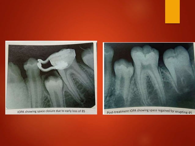 Space regaining procedure in pediatric dentistry | PPTX | Dental Health ...