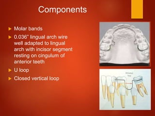 Space regaining procedure in pediatric dentistry | PPTX