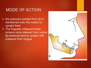 Space regaining procedure in pediatric dentistry | PPTX