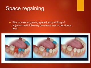 Space regaining procedure in pediatric dentistry | PPTX