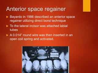 Space regaining procedure in pediatric dentistry | PPTX