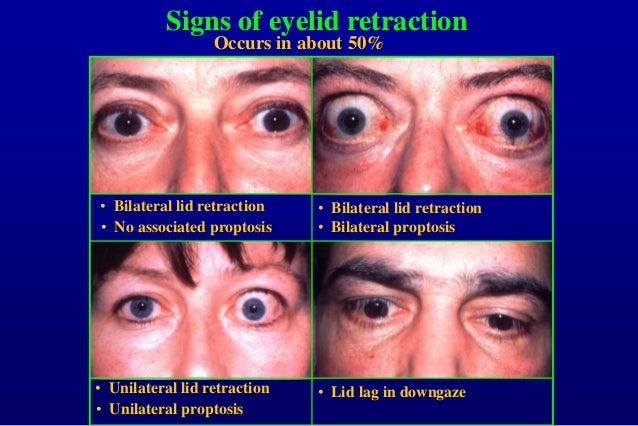 What Is Lid Lag With Pictures Thyroid Eye Disease: A Southeast Asian