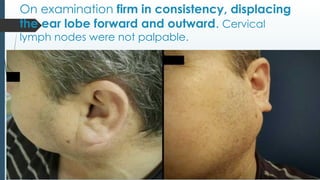 enlarged parotid swelling diagnosis and management.ppt