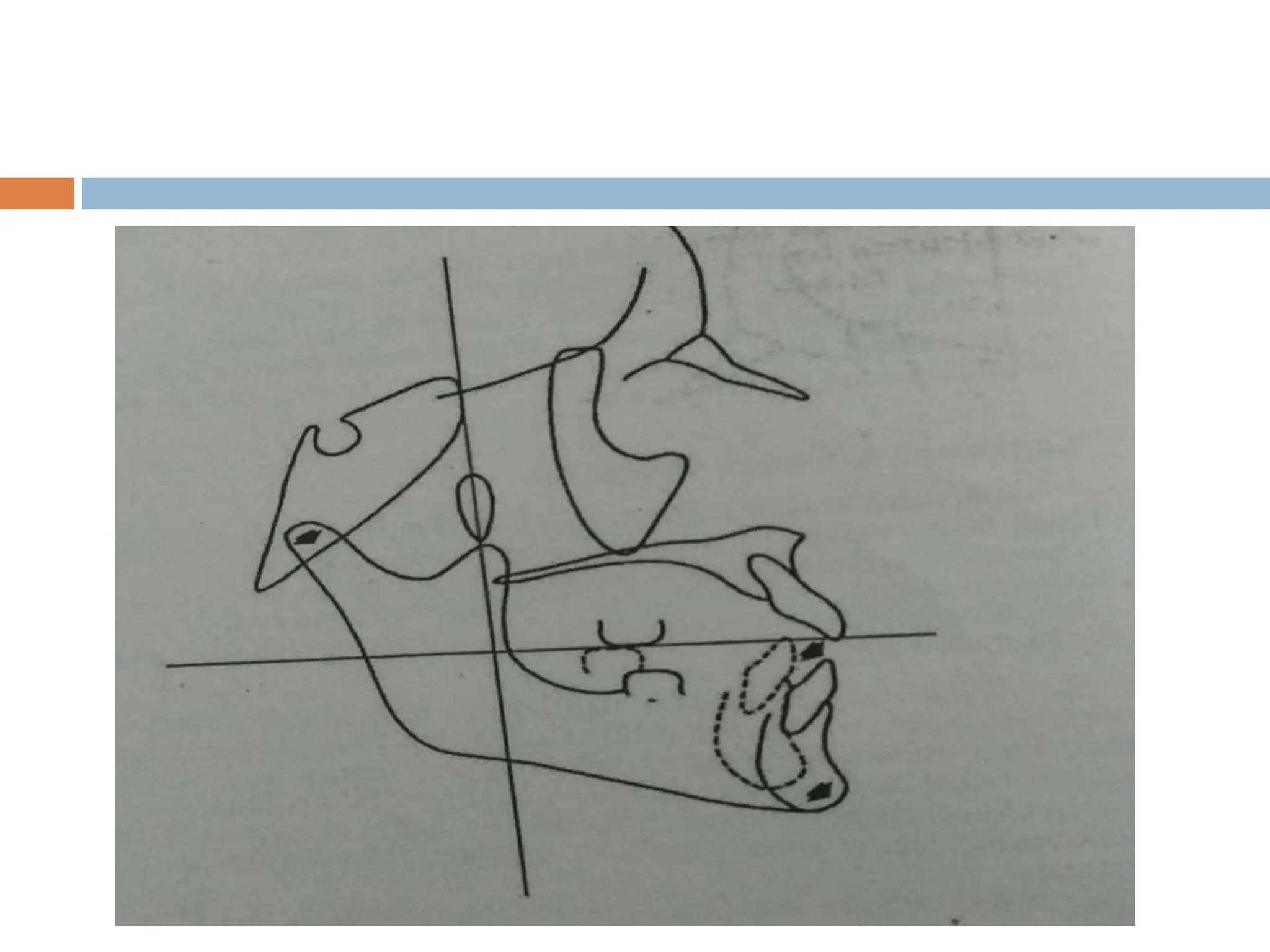 ENLOW’S ‘V’ & COUNTERPART PRINCIPLE by Dr. Sourabh Dutta.pptx