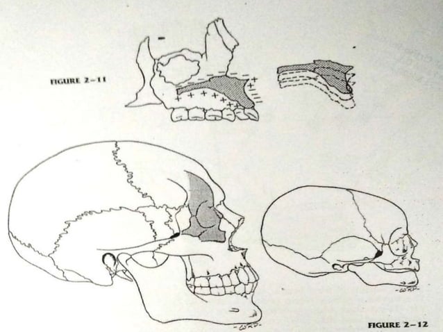 ENLOW’S ‘V’ & COUNTERPART PRINCIPLE by Dr. Sourabh Dutta.pptx