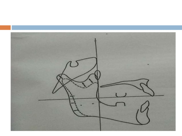 ENLOW’S ‘V’ & COUNTERPART PRINCIPLE by Dr. Sourabh Dutta.pptx
