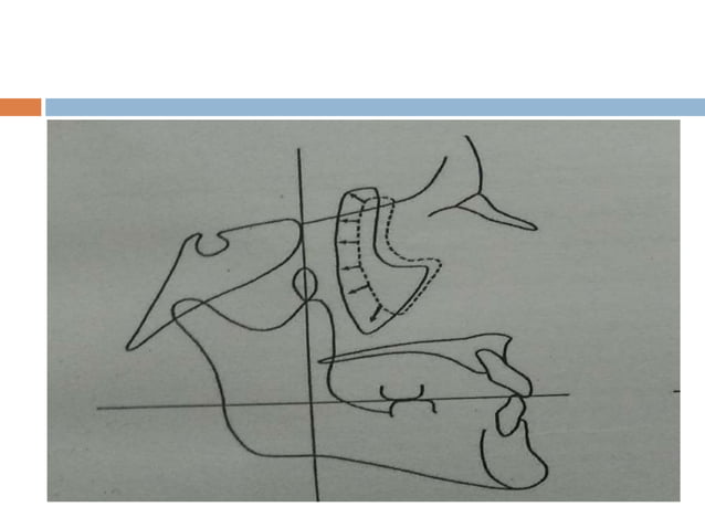 ENLOW’S ‘V’ & COUNTERPART PRINCIPLE by Dr. Sourabh Dutta.pptx