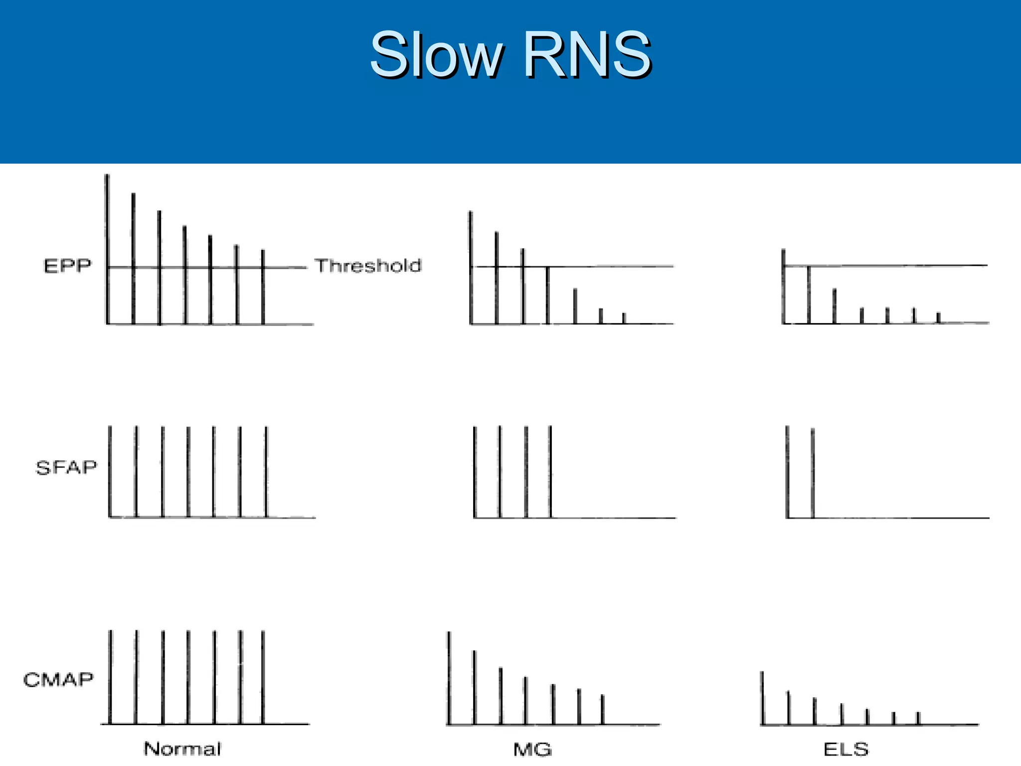 repetitive nerve stimulation | PPT