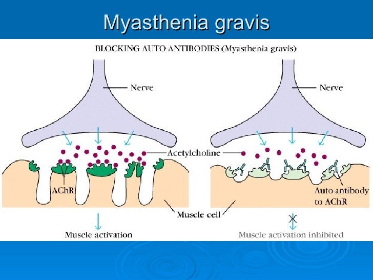 repetitive nerve stimulation