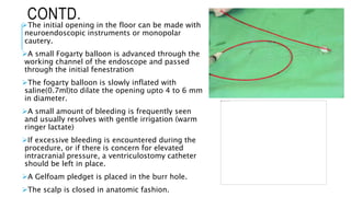 endoscopic third ventriculostomy and care.pptx