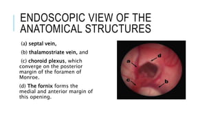 endoscopic third ventriculostomy and care.pptx