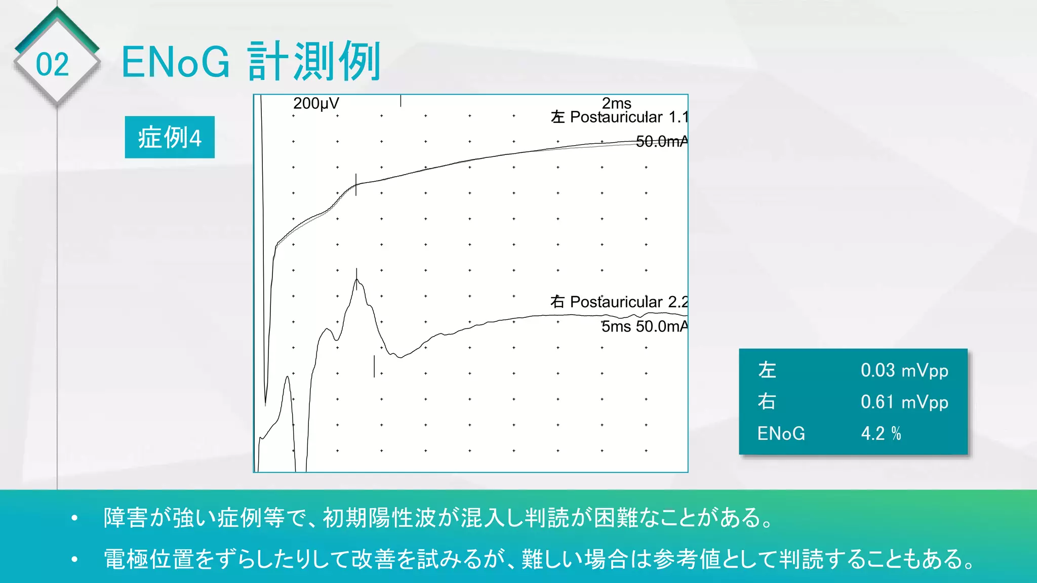顔面神経麻痺の検査とENoGの基礎 | PPTX