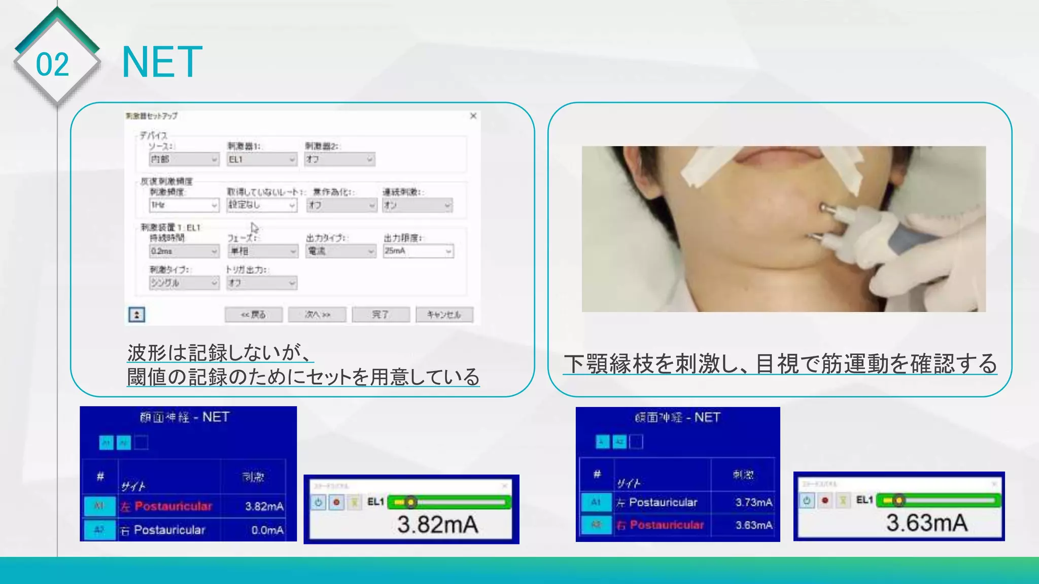 顔面神経麻痺の検査とENoGの基礎 | PPTX
