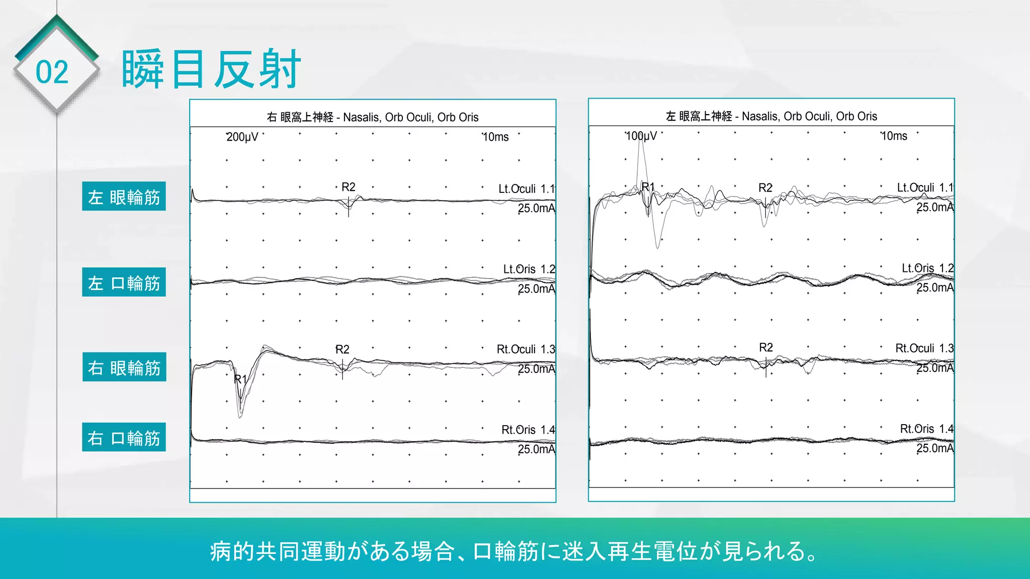 顔面神経麻痺の検査とENoGの基礎 | PPTX