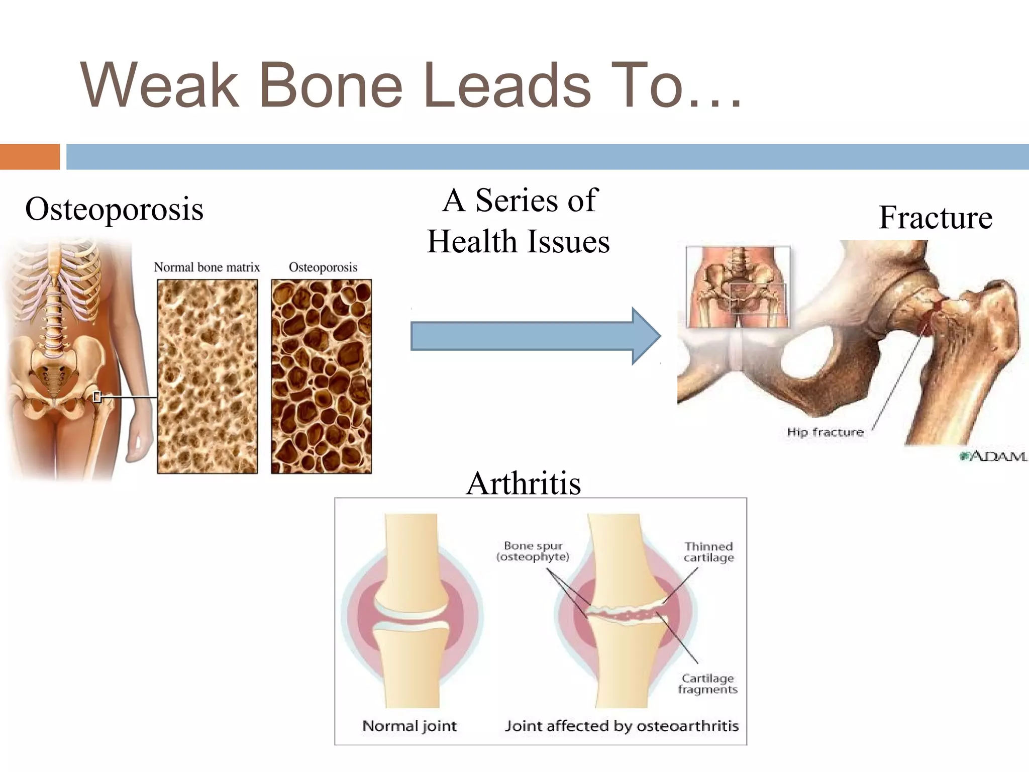 Ensuring Better Bone Health | PPT