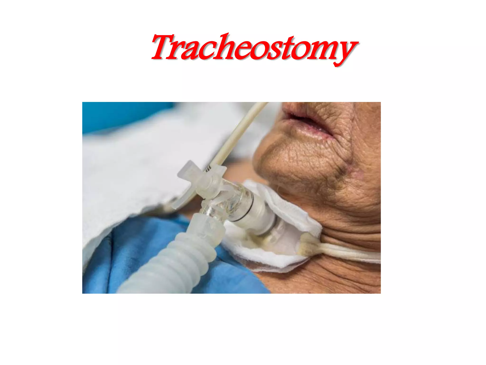Tracheostomy | PPT