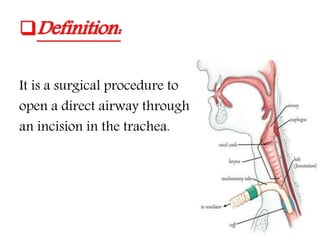 Tracheostomy | PPT