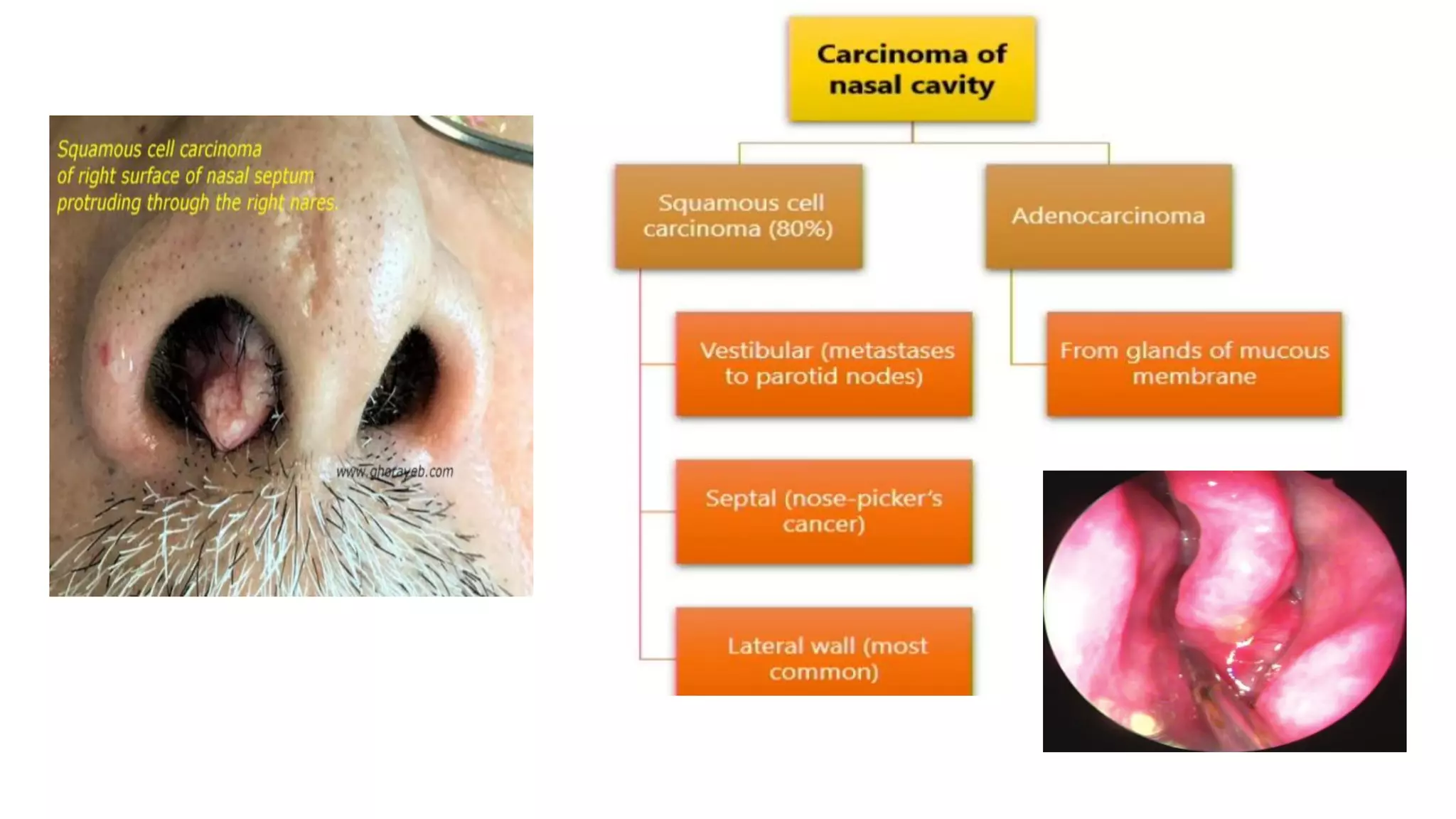 Malignant tumors of Nose and PNS | PDF