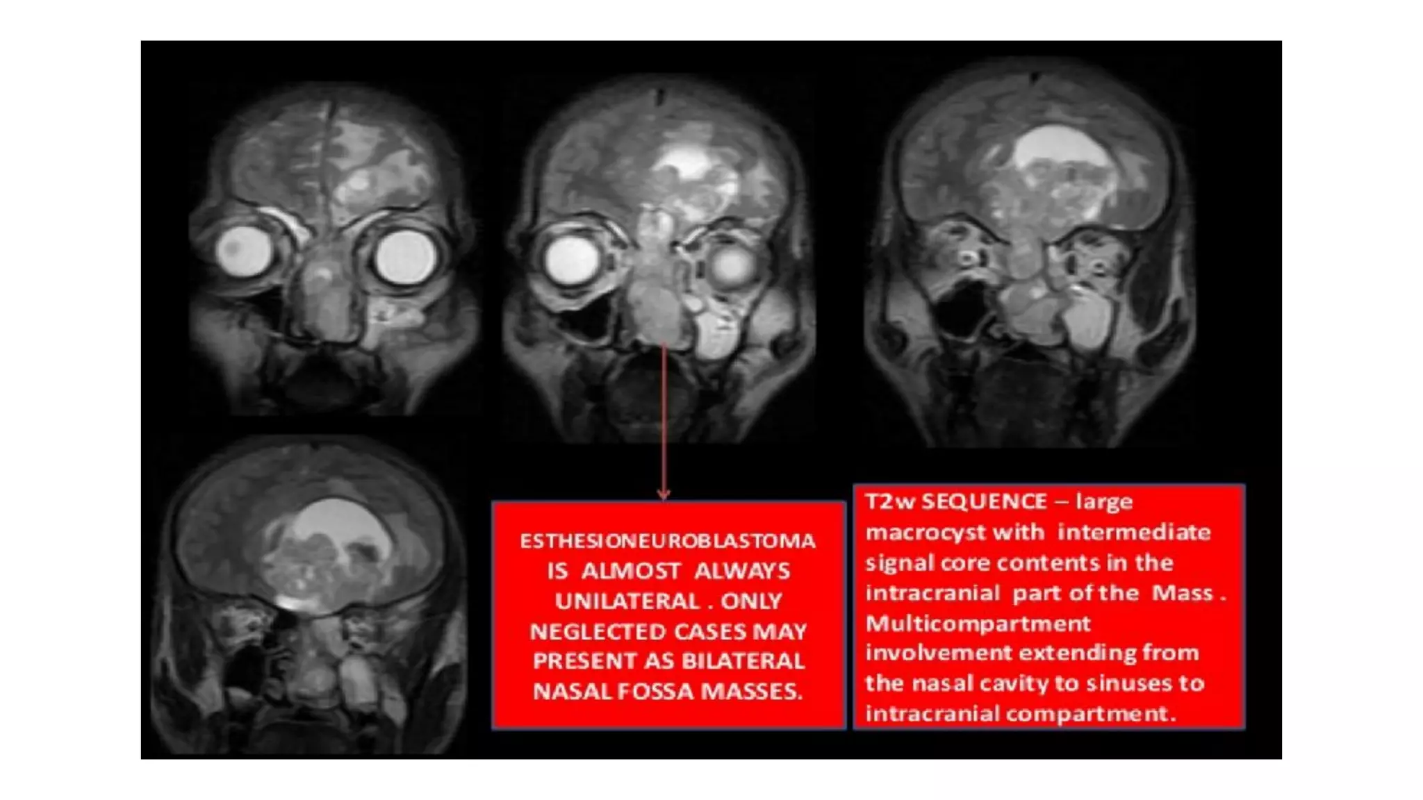 Malignant tumors of Nose and PNS | PDF