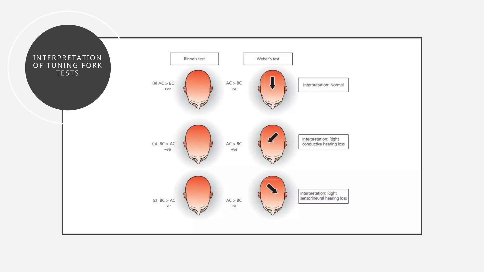 Tuning fork tests - ENT | PPTX