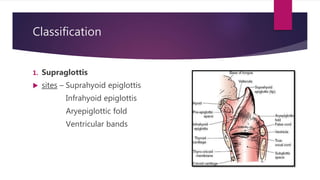 ENT - Carcinoma of Larynx | PPTX