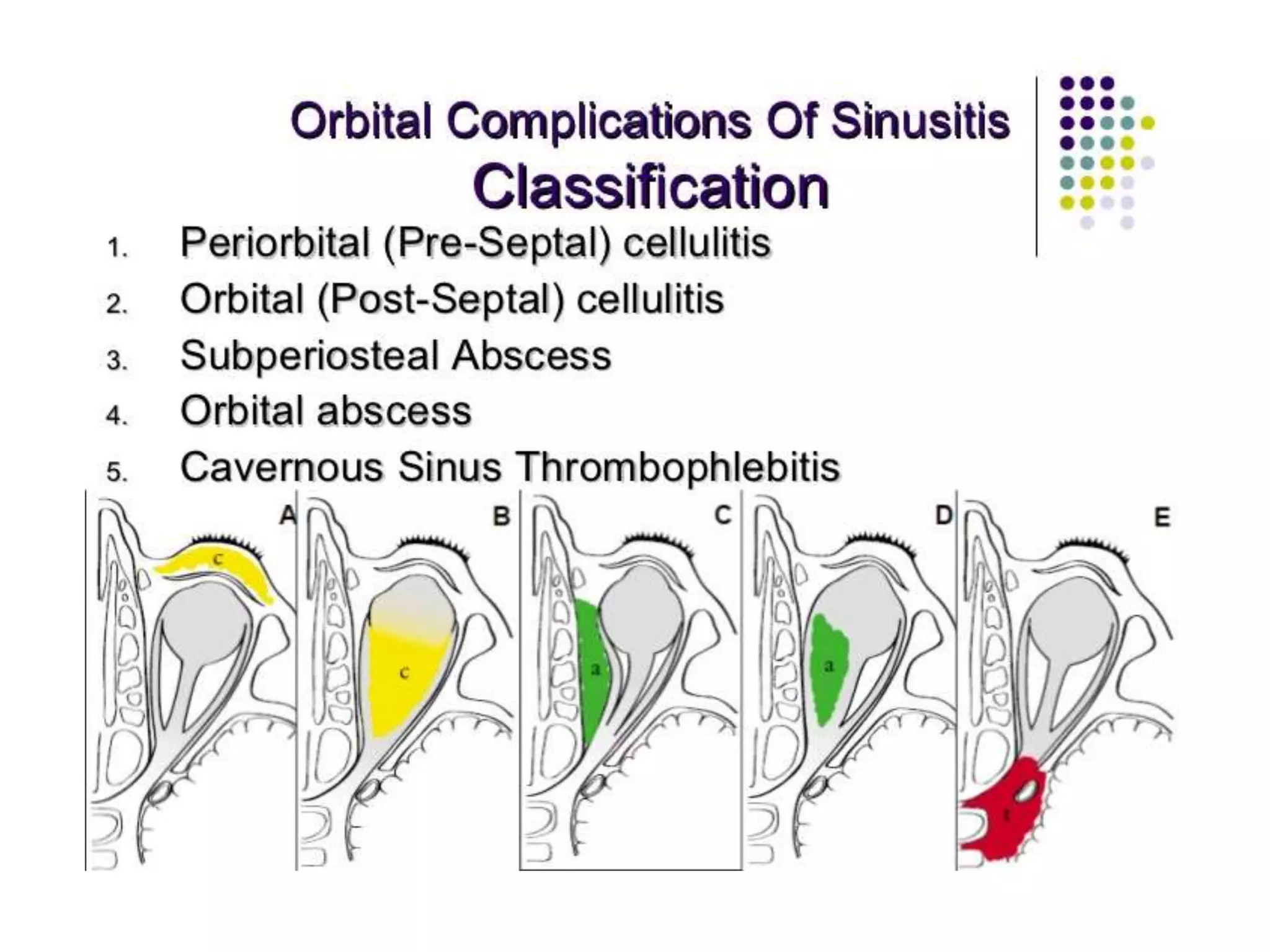 ENT - Sinusitis.pptx