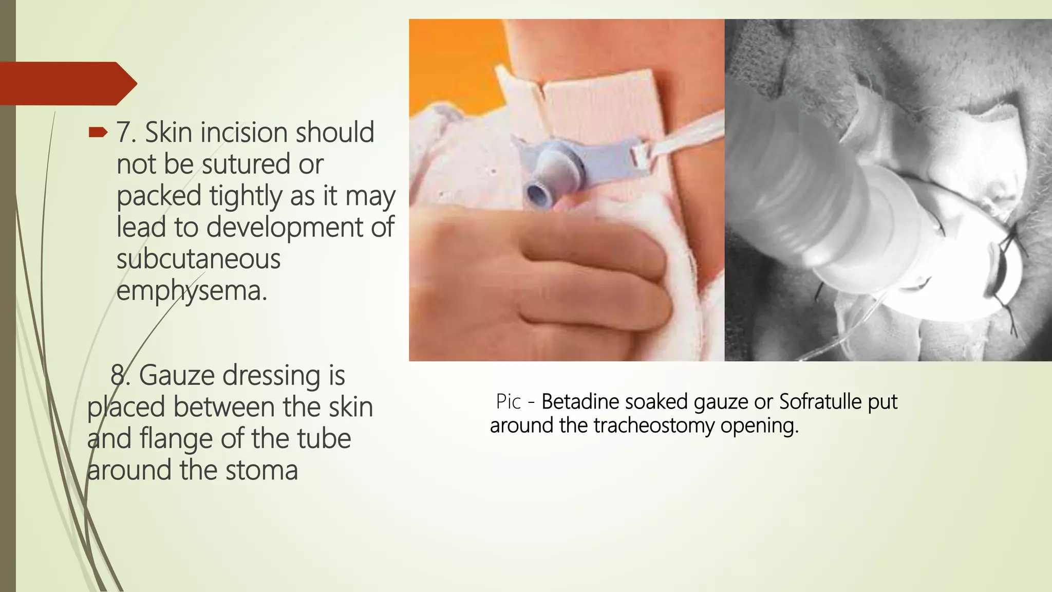 TRACHEOSTOMY | PPTX
