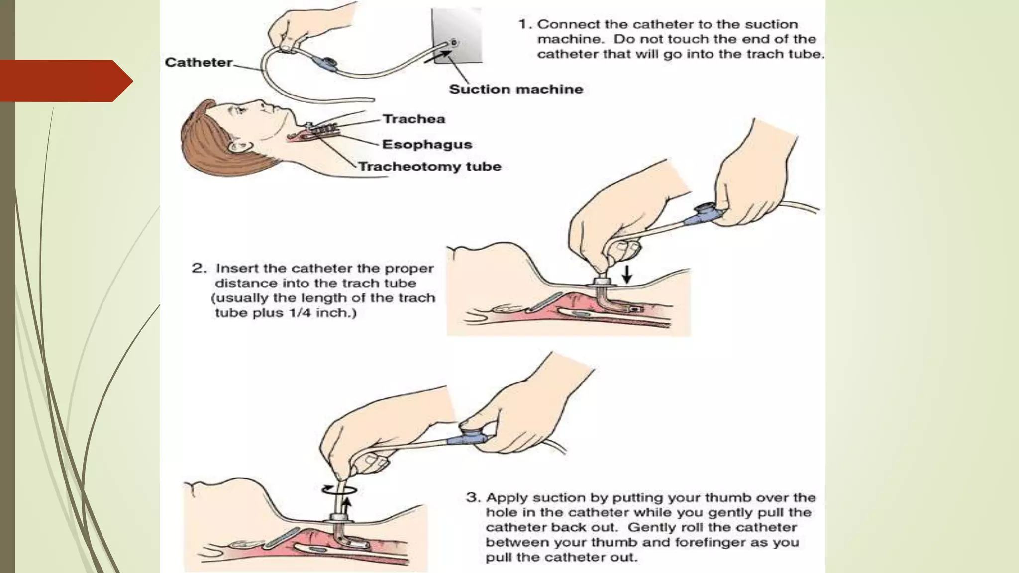 TRACHEOSTOMY | PPTX