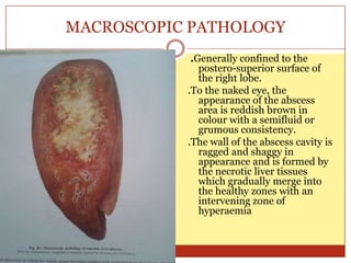 ppt on Entamoeba histolytica extra intestinal lesions | PPT