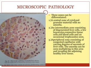 ppt on Entamoeba histolytica extra intestinal lesions | PPTX