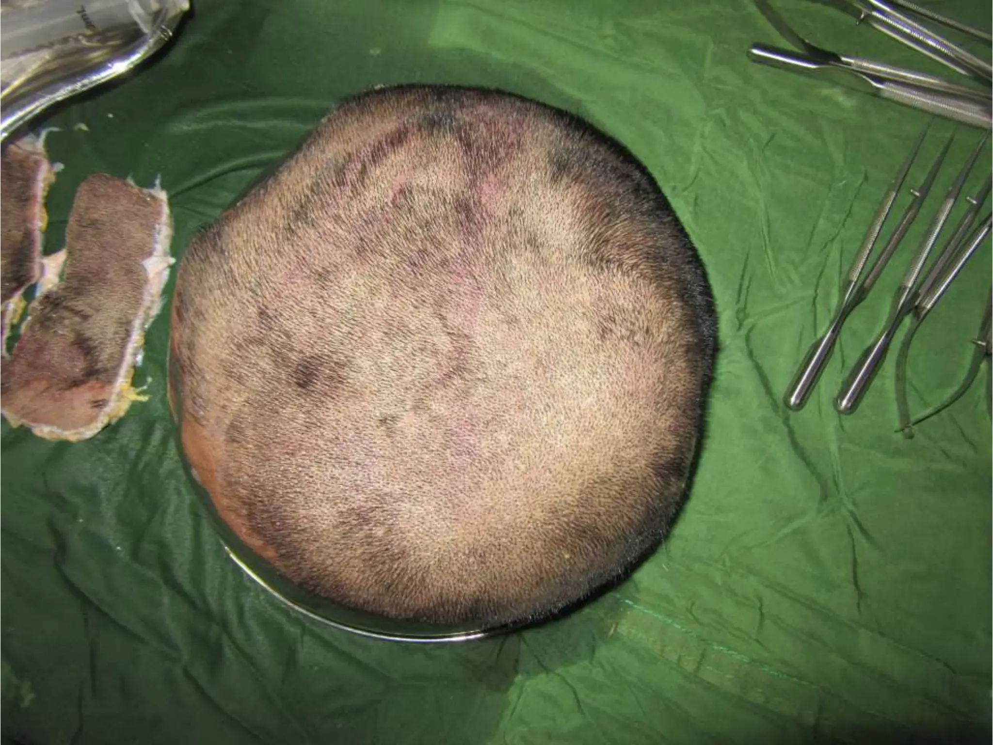 ENTANGLEMENT INJURIES .pptx